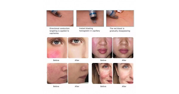 Aparat Dioda Laser 980nm Indepartare venectazii, Vase capilare sparte ...