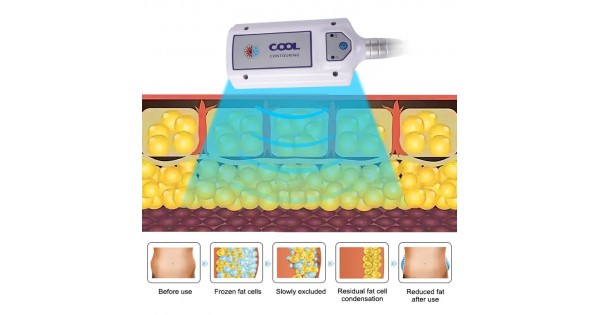 Aparat Criolipoliza palete criogenice, Cryo-Plates EMS RF Criolipoliză ...